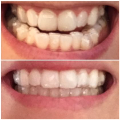 Invisalign Journey Month 5: What You Should Know ⋆ Green and Clean Mom Blog